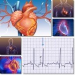 Extrasystoles and the Heart: Symptoms, Causes and Remedies (What I ...